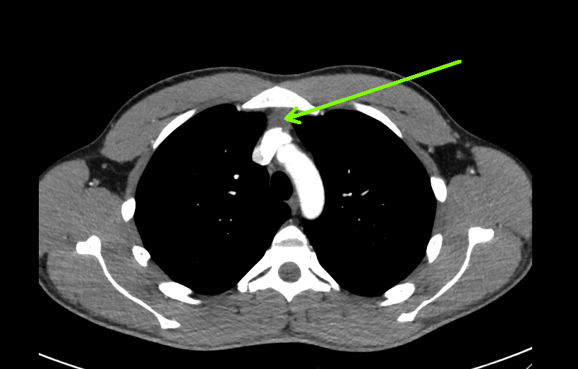 Chirurgie Thoracique Toulouse - Dr Olivier PAGES