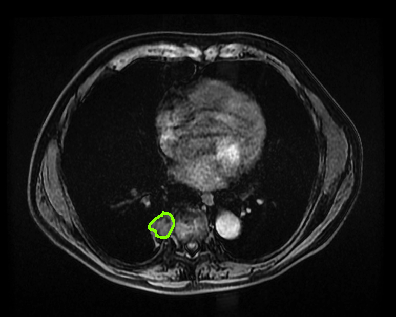Chirurgie Thoracique Toulouse - Dr Olivier PAGES